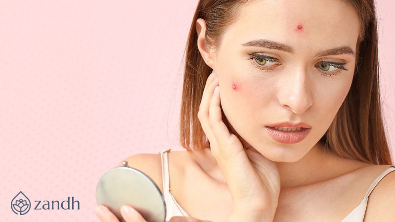 Acne adulta: o que a causa e qual a melhor prevenção? - zandh